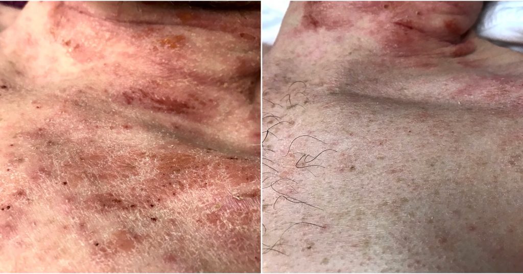 Eczema and Topical Steroid Withdrawal - The Movement Clinic | The ...